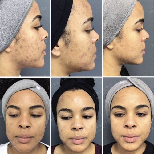 Skin Transformation Series — The Aesthetic List - Curated Directory