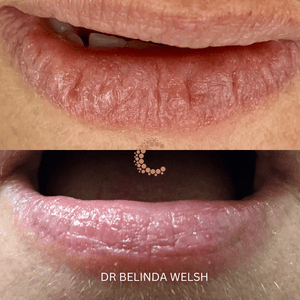 Sun Damaged Lips — Dr Belinda Welsh