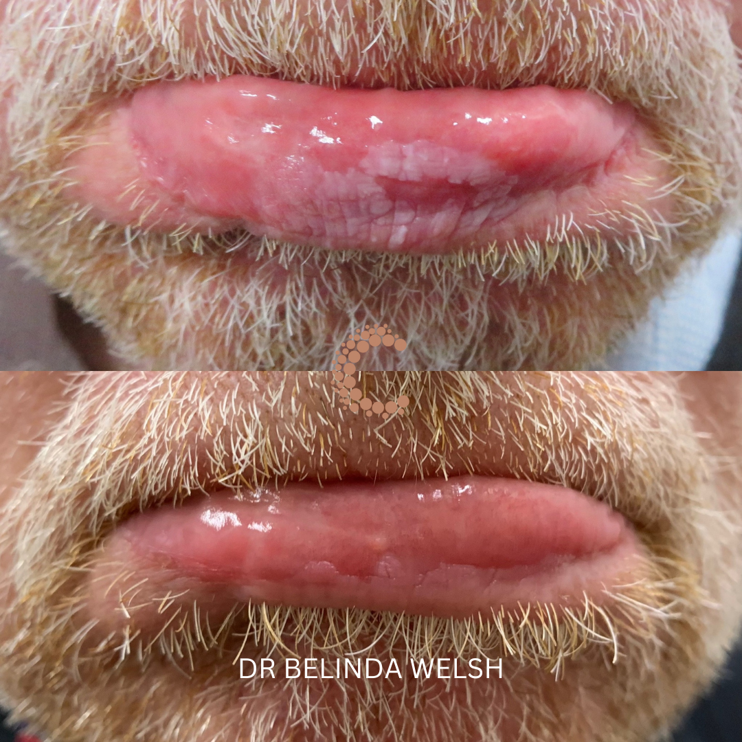 Sun Damaged Lips — Dr Belinda Welsh