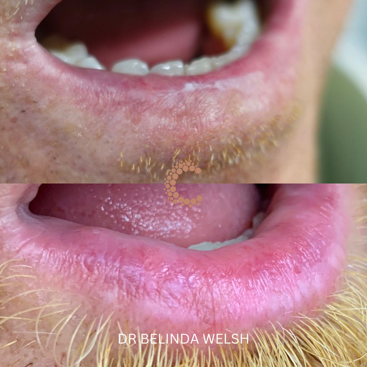 Sun Damaged Lips — Dr Belinda Welsh