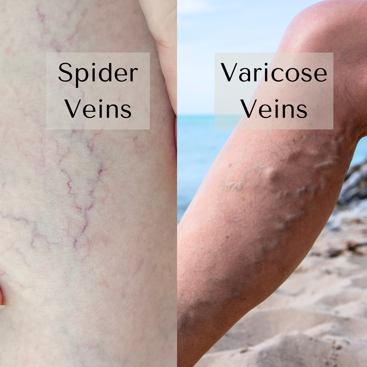Treatment for Spider and Varicose Veins | Melbourne Vein Group
