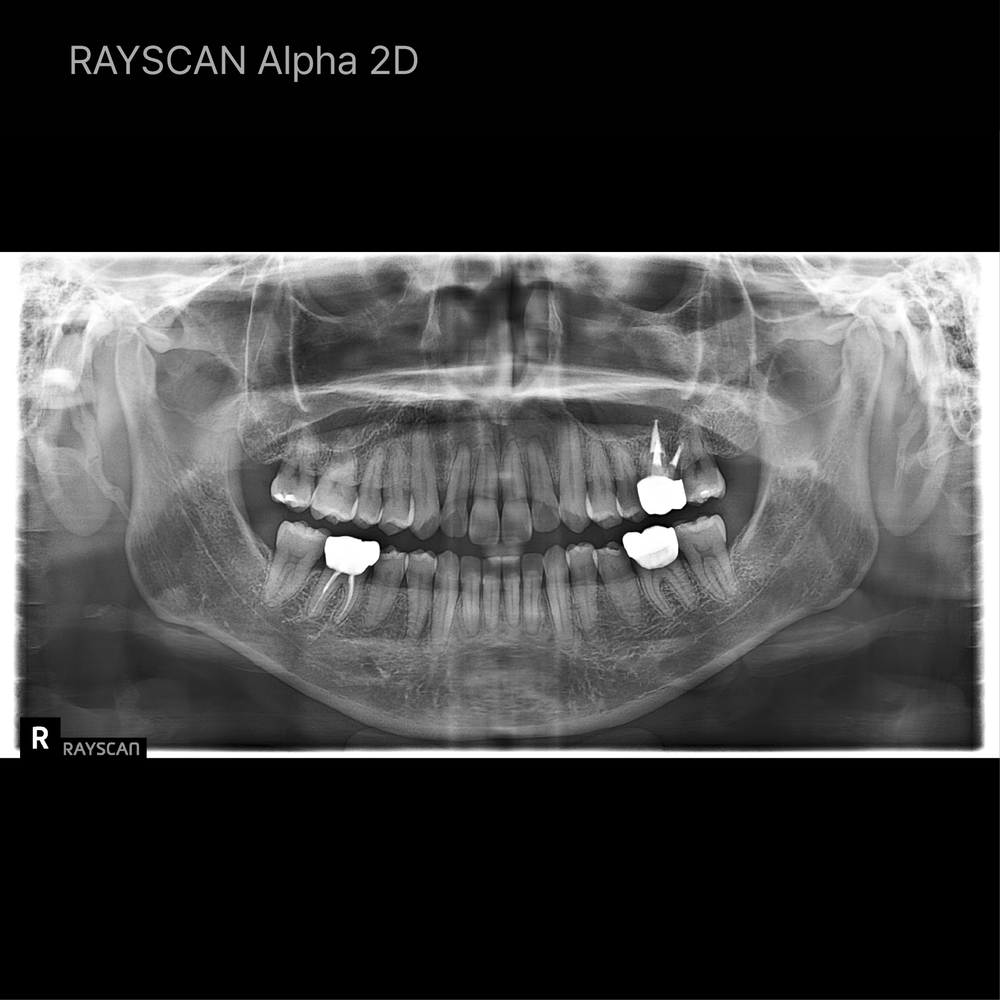 Rayscan Alpha 2D — Ray America