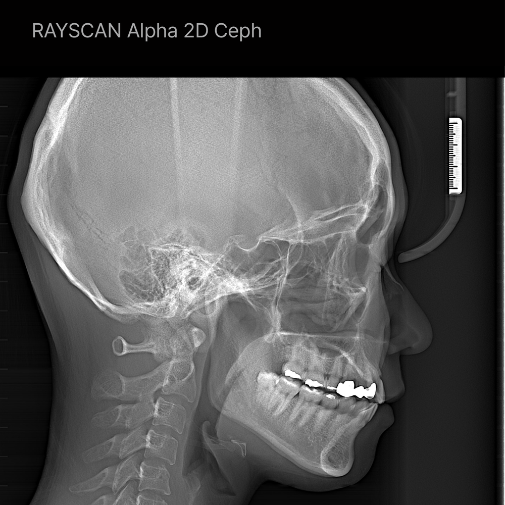 Rayscan Alpha 2D — Ray America