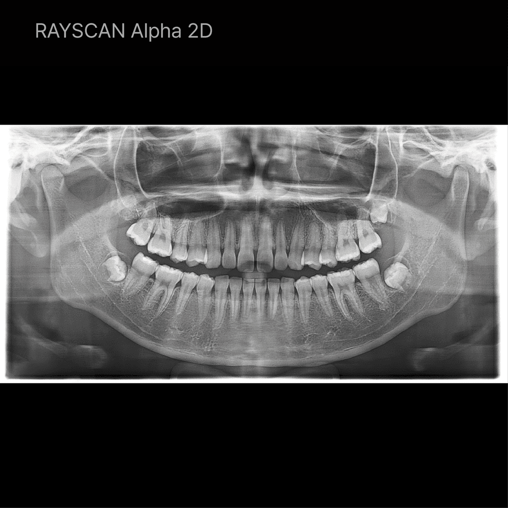 Rayscan Alpha 2D — Ray America