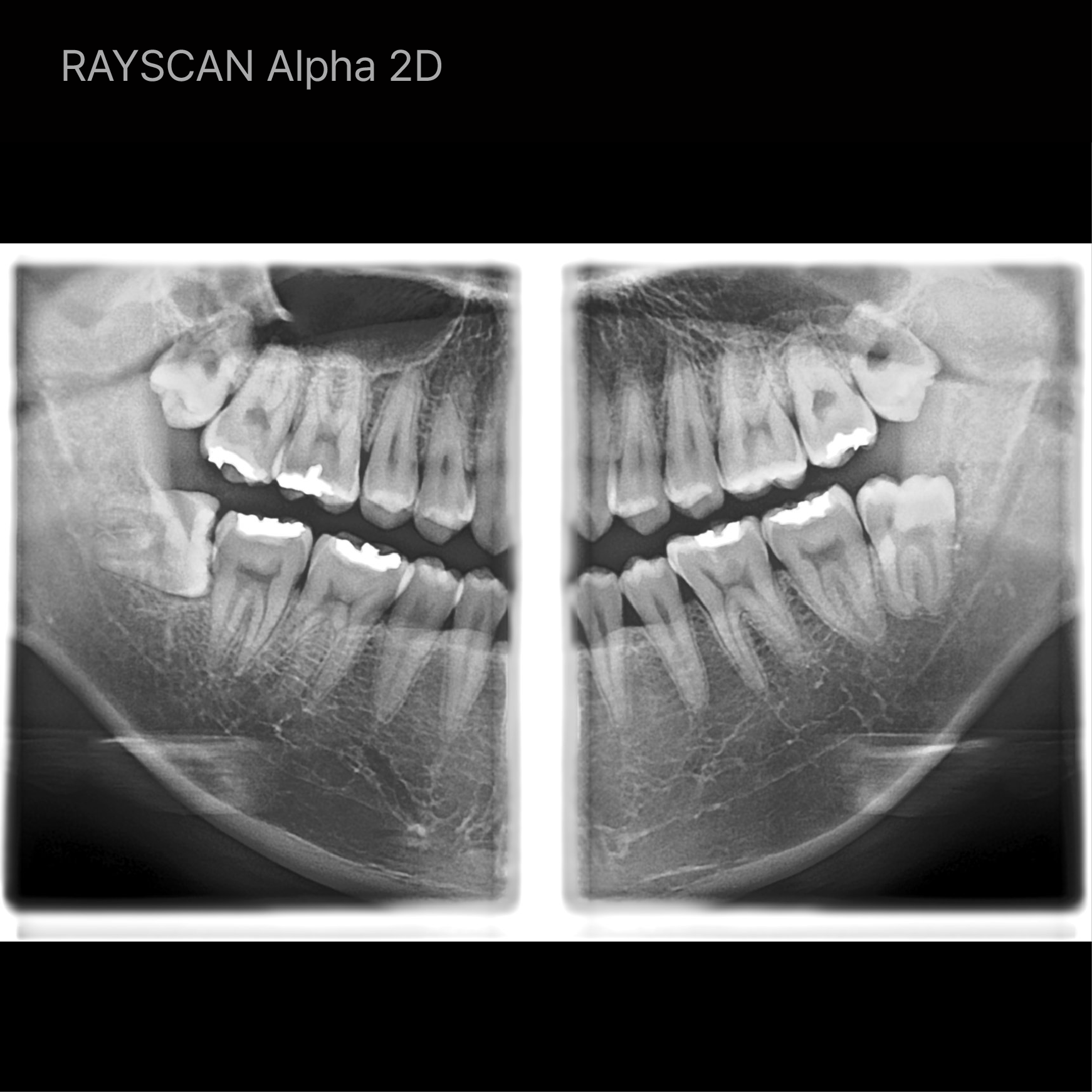 Rayscan Alpha 2D — Ray America