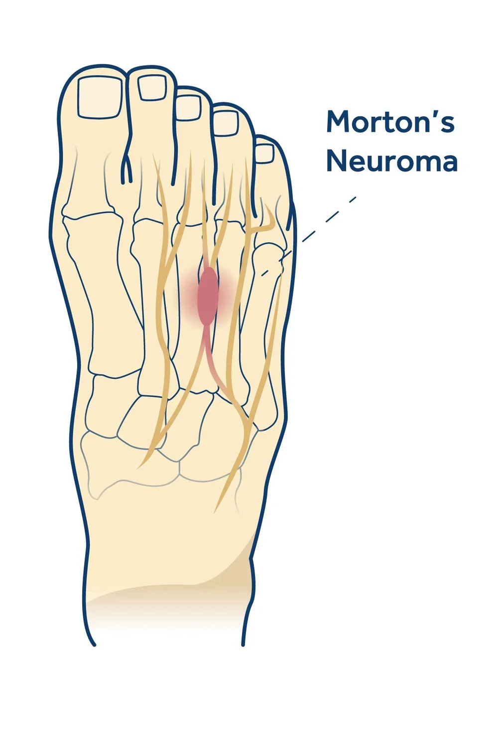 Morton's Neuroma Treatment — Doctor's Inc.