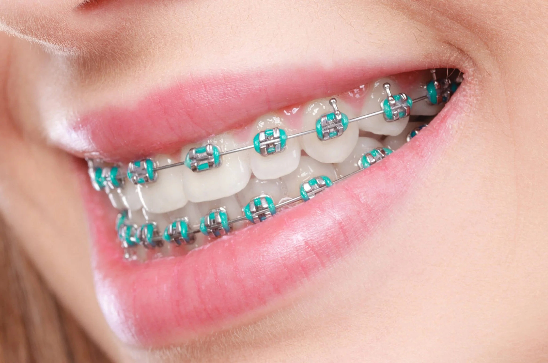 Ortho/Braces | Achieve Your Perfect Smile Today — Excel Dental Clinic