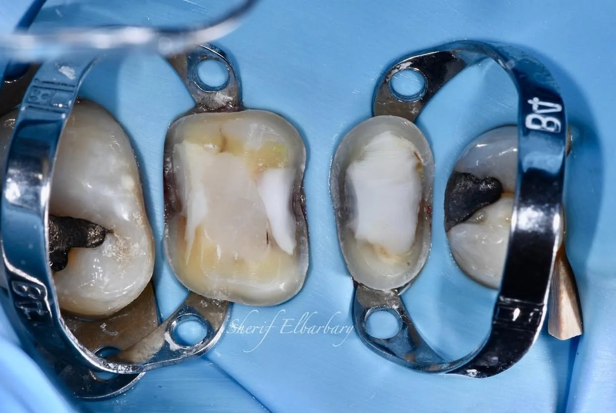 The Prep Master Course:Verti and Beyond — Explore Dentistry