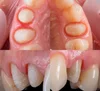 VertiPrep and BOPT concept — Explore Dentistry