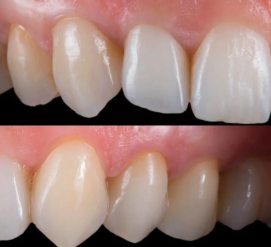 VertiPrep and BOPT concept — Explore Dentistry