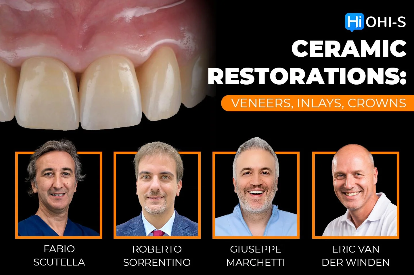 Ceramic restorations: veneers, inlays, crowns — Explore Dentistry
