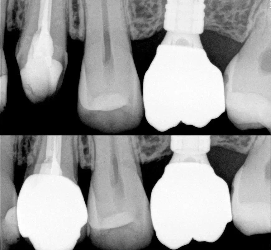 VertiPrep and BOPT concept — Explore Dentistry