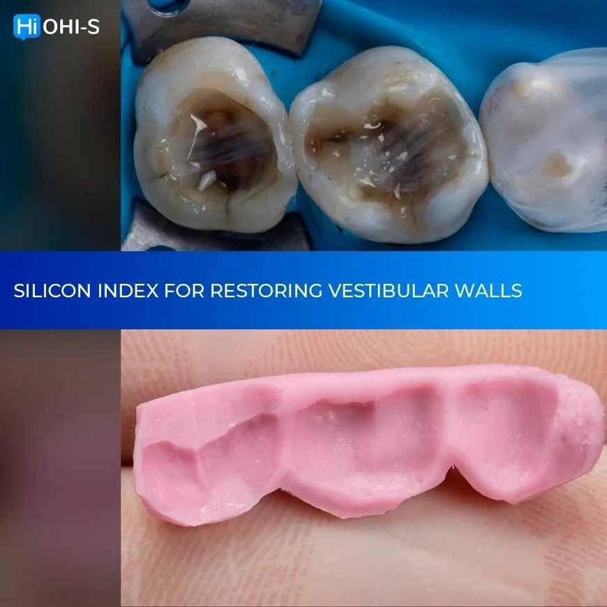 The Biomimetic concept: composite restoration protocols — Explore Dentistry