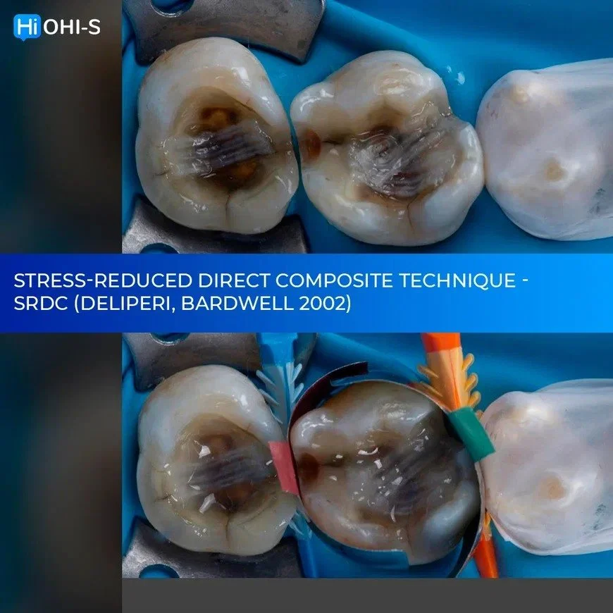 The Biomimetic concept: composite restoration protocols — Explore Dentistry