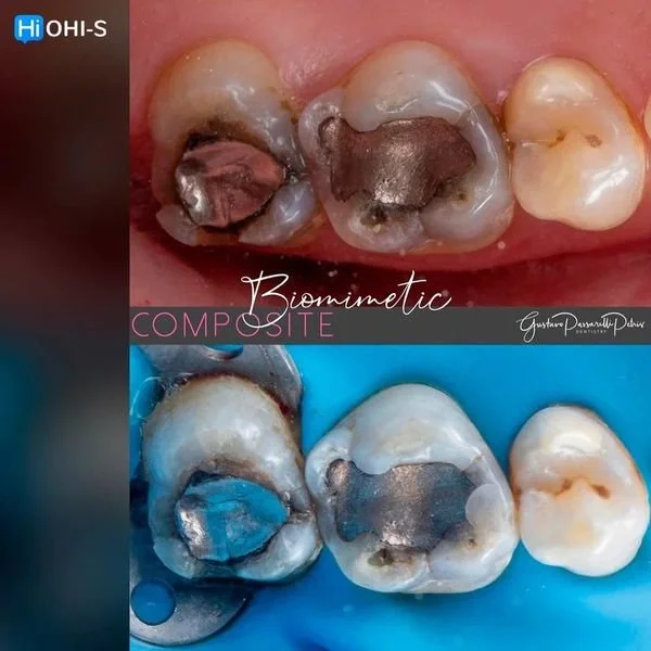 The Biomimetic concept: composite restoration protocols — Explore Dentistry