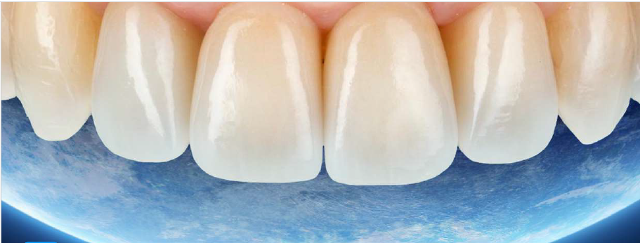 VertiPrep and BOPT concept — Explore Dentistry