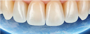 VertiPrep and BOPT concept — Explore Dentistry