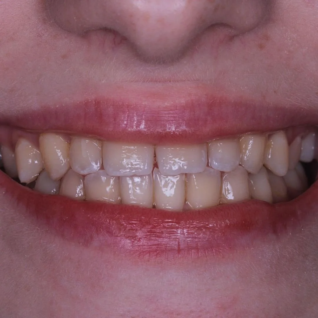 Dental bleaching: the science based techniques for every day — Explore ...