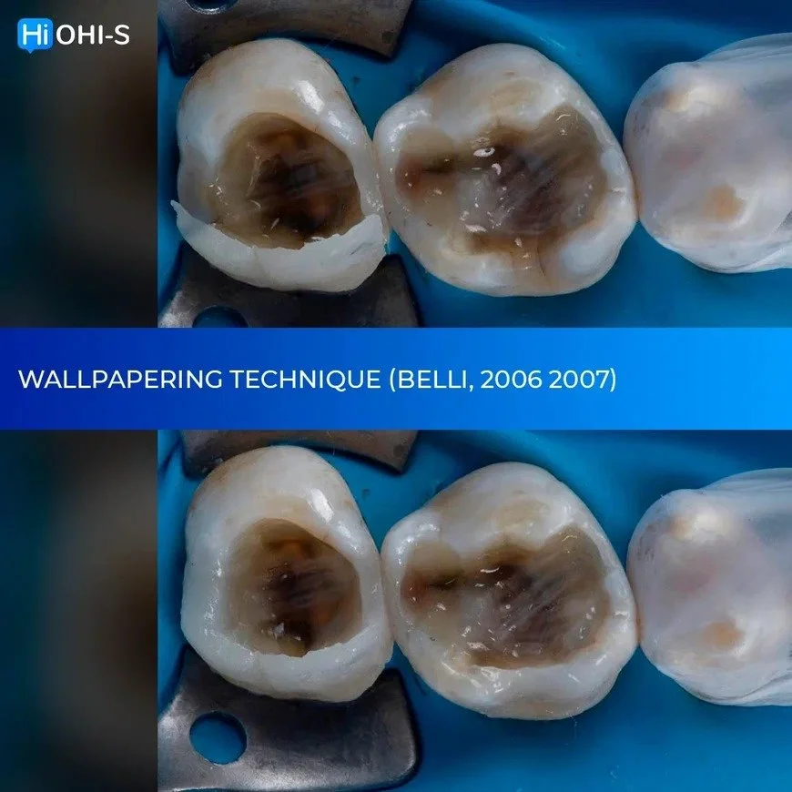 The Biomimetic concept: composite restoration protocols — Explore Dentistry