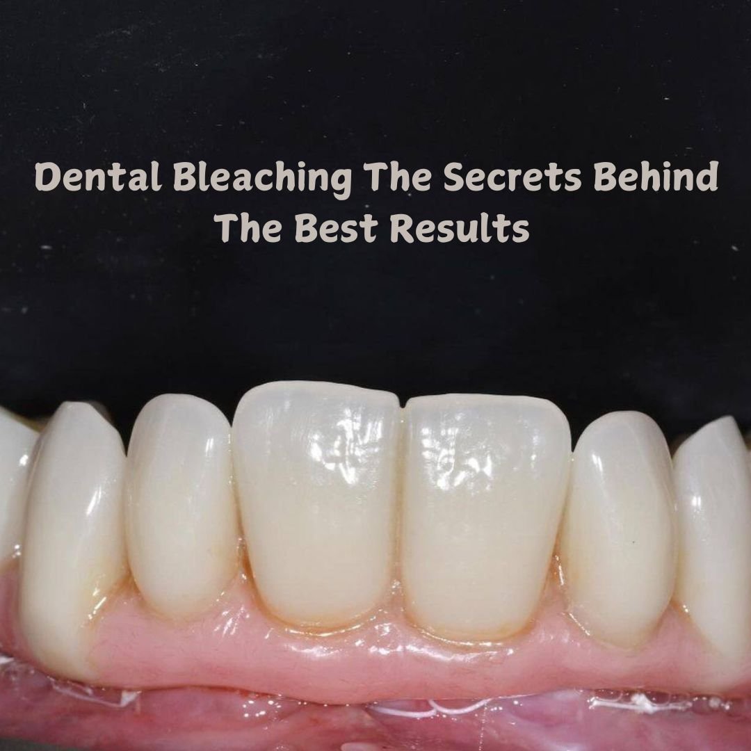 Dental Bleaching — Explore Dentistry