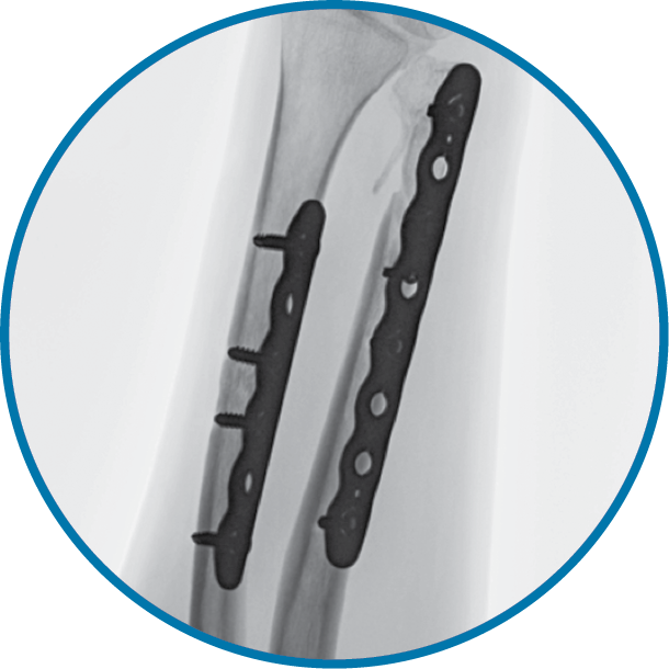 SPL-Procedure — StabilizOrtho