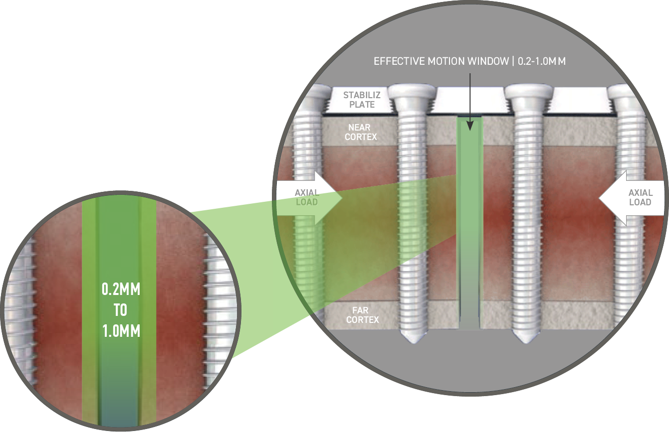 SPL-Technology — StabilizOrtho