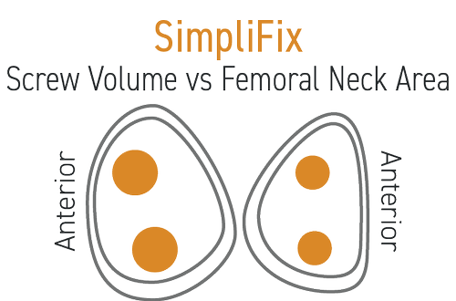 SimpliFix-Technology — StabilizOrtho