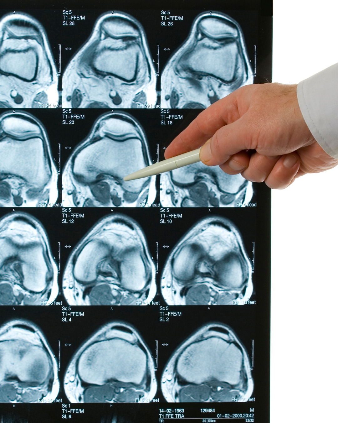 ACL Cross Bracing Protocol Guide — Kaylana Wellness Collective