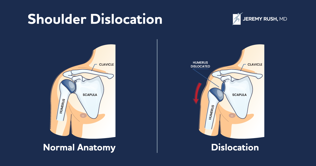 Shoulder Instability and Dislocation in Children: Causes, Treatments ...