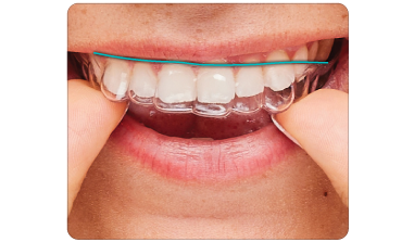 ClearCorrect — Transforme