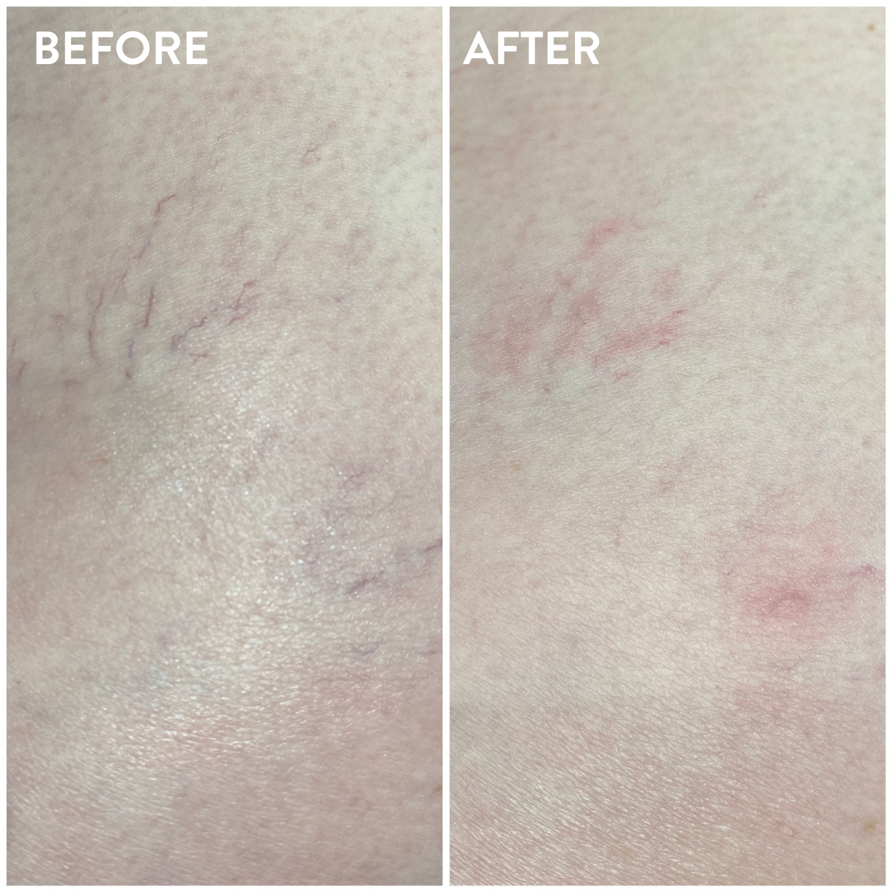 Laser Veins Removal — OFF & ON