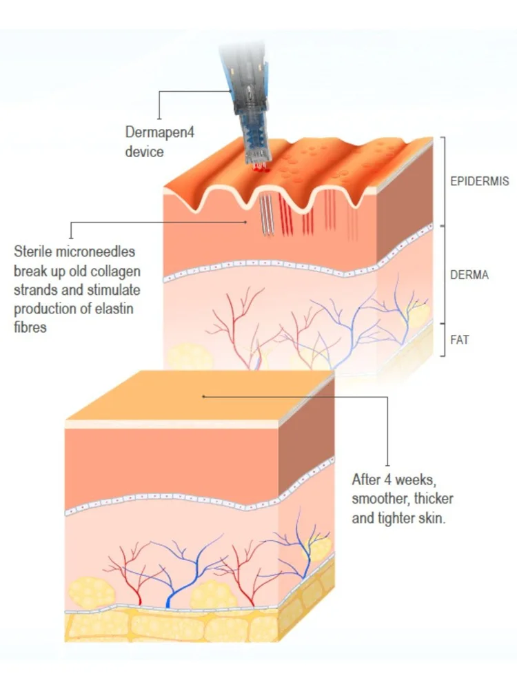 Dermal Needling — OFF & ON