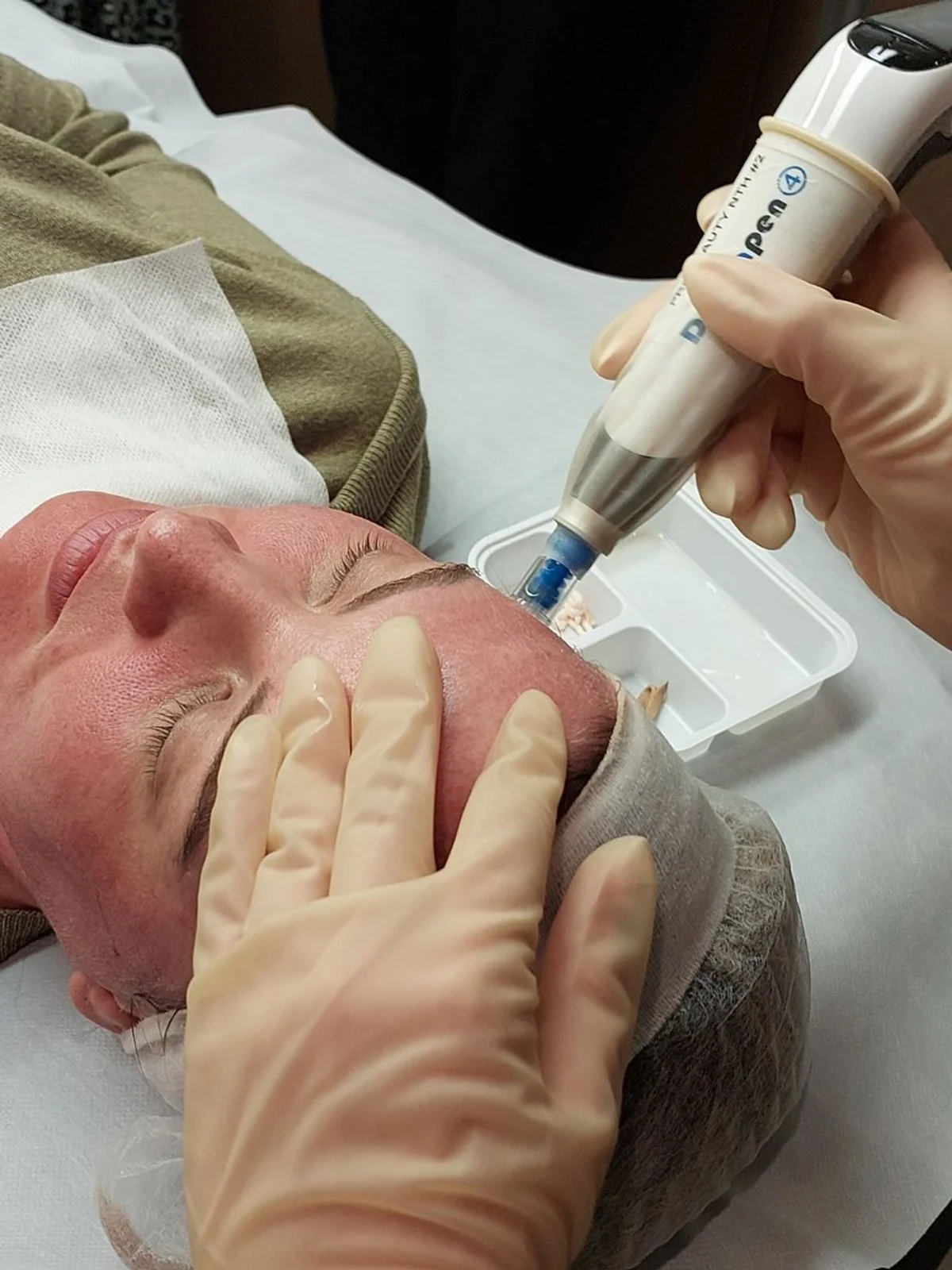 Dermal Needling — OFF & ON