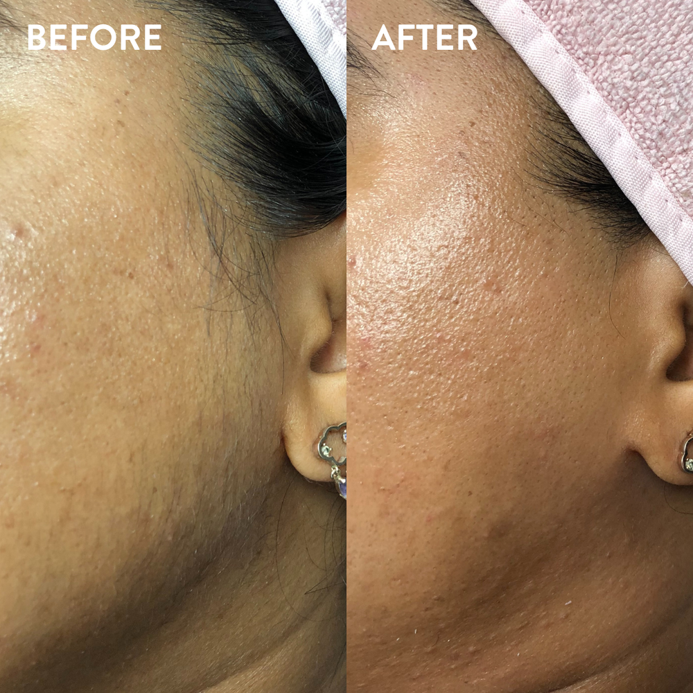 Dermaplaning — OFF & ON
