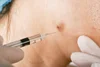 Can’t Get Rid of Those Deep, Under-the-Skin Bumps? Let’s Talk Nodular ...