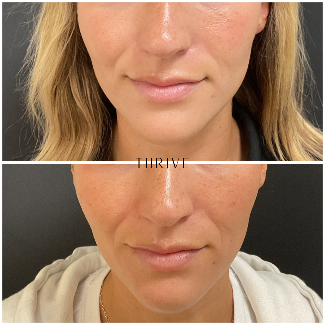 Masseter Botox Guide: How It Works, Results, and What to Expect ...