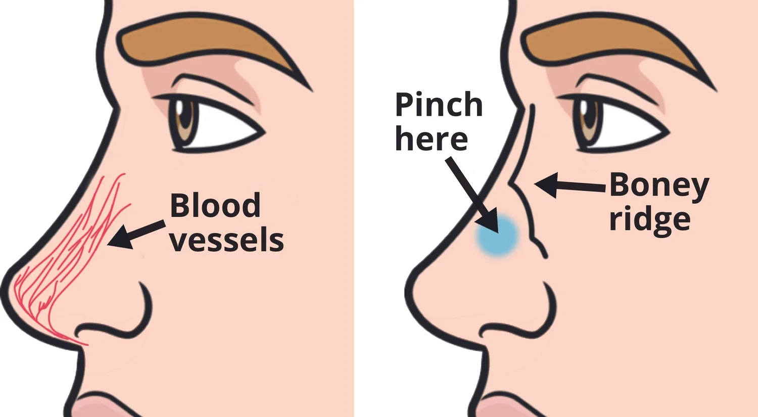 Navigating Nosebleeds: Causes, Prevention, and Care — BioMatrix Specialty Infusion Pharmacy