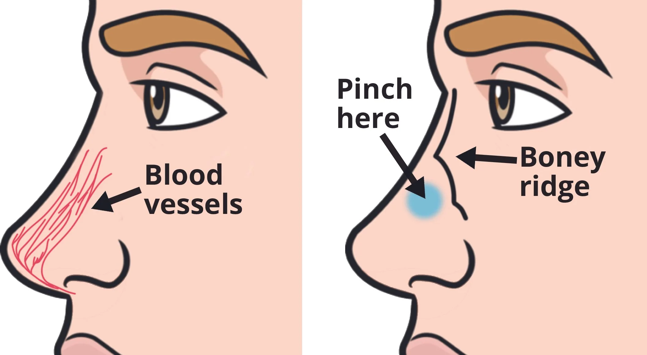 Navigating Nosebleeds: Causes, Prevention, and Care — BioMatrix ...