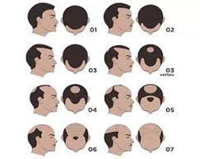 Male Pattern Baldness — True Vertex