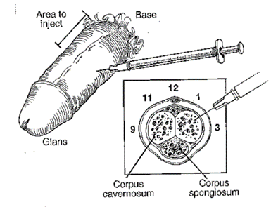 Trimix Injections — True Vertex