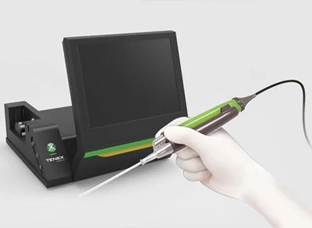Tenotomy | Tenex | Minimally Invasive Surgical Techniques