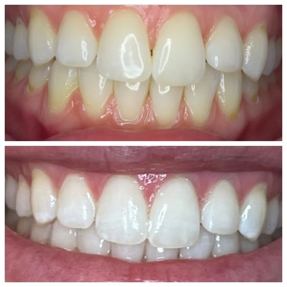 BEFORE & AFTER — PEARLY TEETH OBX
