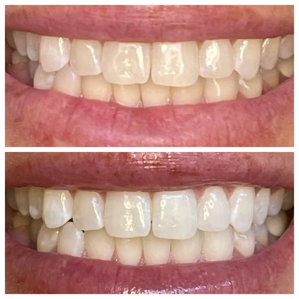 BEFORE & AFTER — PEARLY TEETH OBX