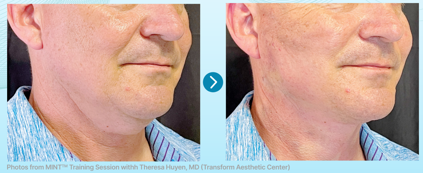 PDO Thread Lift in Lake Oswego, OR — ALMĀS Laser & Facial Aesthetics