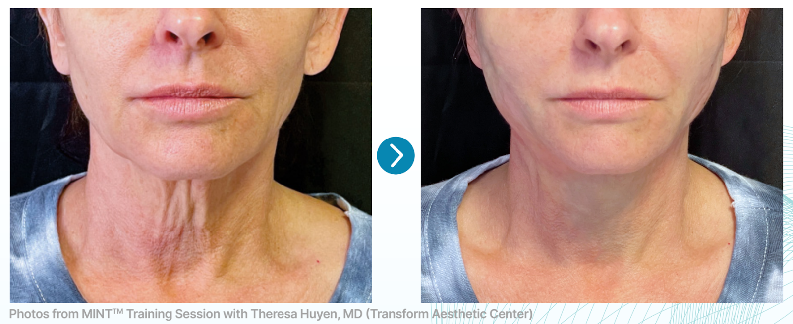 PDO Thread Lift in Lake Oswego, OR — ALMĀS Laser & Facial Aesthetics