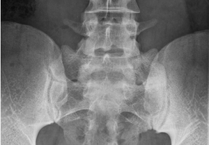 Bertolotti's Syndrome Society | Learn about Bertolotti's Syndrome