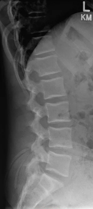 X-Ray imaging protocol | Bertolotti's Syndrome Society ...