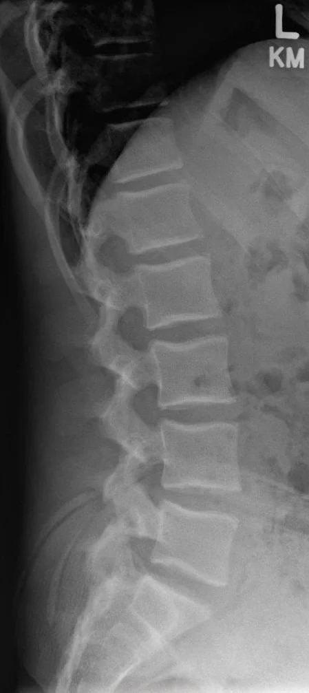 X-Ray imaging protocol | Bertolotti's Syndrome Society ...