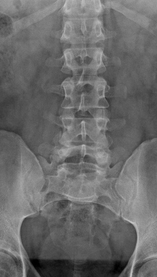 X-Ray imaging protocol | Bertolotti's Syndrome Society ...