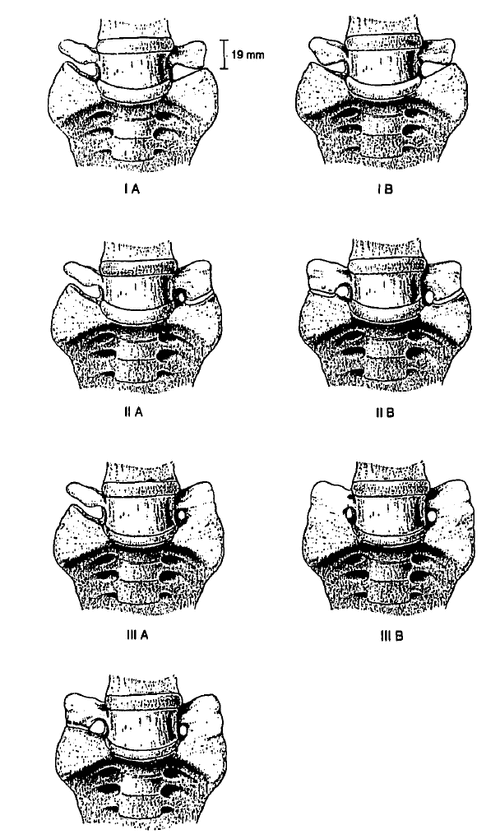 About Bertolotti's Syndrome